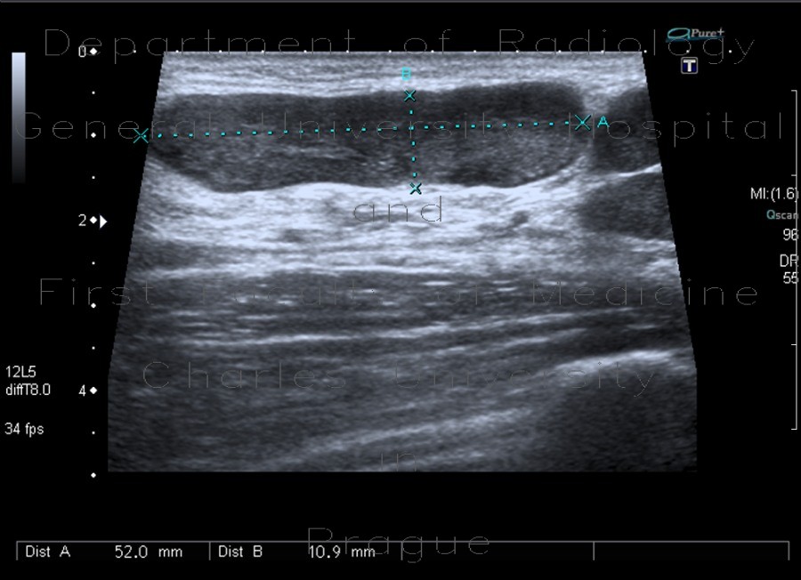Groin Lymph Nodes Ultrasound